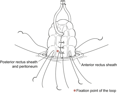 Colostomy: Creation and Closure | SpringerLink