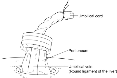Colostomy: Creation and Closure | SpringerLink