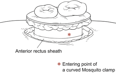 Colostomy: Creation and Closure | SpringerLink