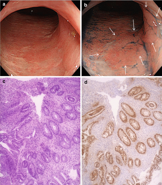 Surveillance Colonoscopy | SpringerLink