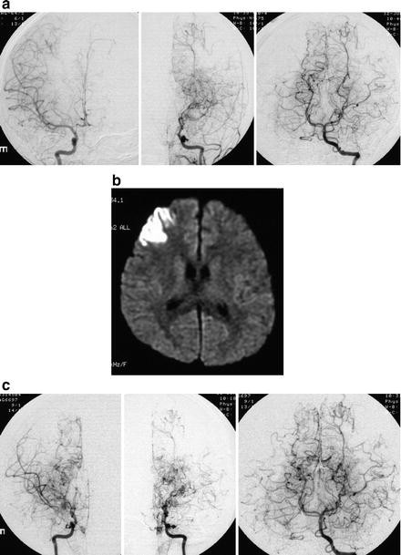 Progression of Moyamoya Disease | SpringerLink