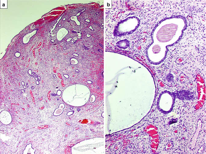 Pathology of Endometrial Hyperplasia and Carcinoma | SpringerLink