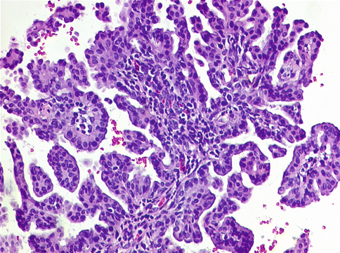 Pathology of Endometrial Hyperplasia and Carcinoma | SpringerLink