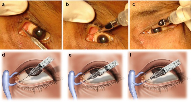 Evaluation of Epiphora | SpringerLink