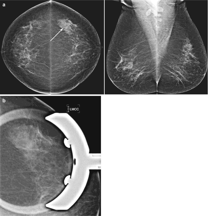 The Normal Breast | SpringerLink