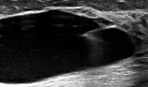 Fibrocystic Change: Involutionary Changes–Breast Cysts | SpringerLink