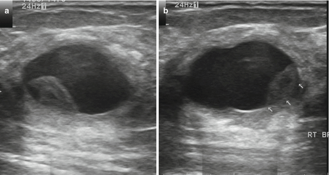 Fibrocystic Change: Involutionary Changes–Breast Cysts | SpringerLink