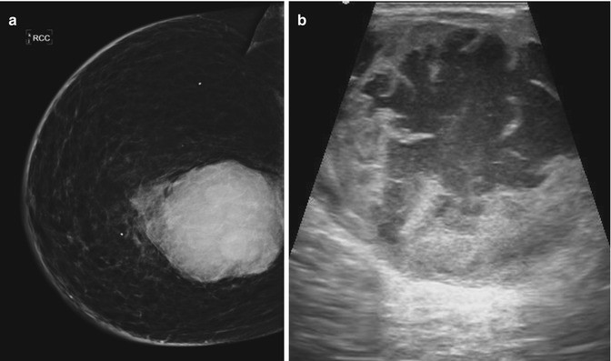 Fibrocystic Change: Involutionary Changes–Breast Cysts | SpringerLink
