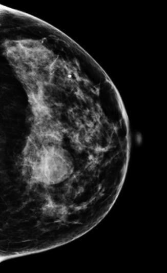Fibrocystic Change: Involutionary Changes–Breast Cysts | SpringerLink