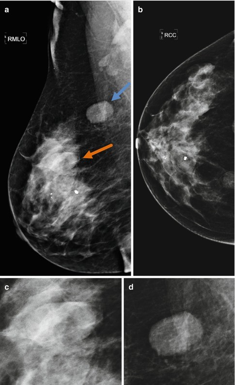 Fibroadenoma | SpringerLink