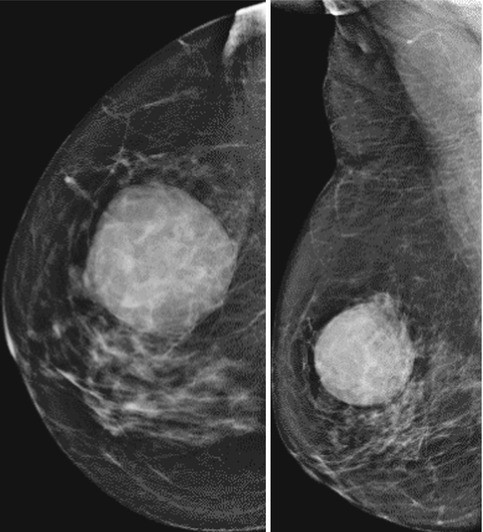 Phyllodes Tumors | SpringerLink
