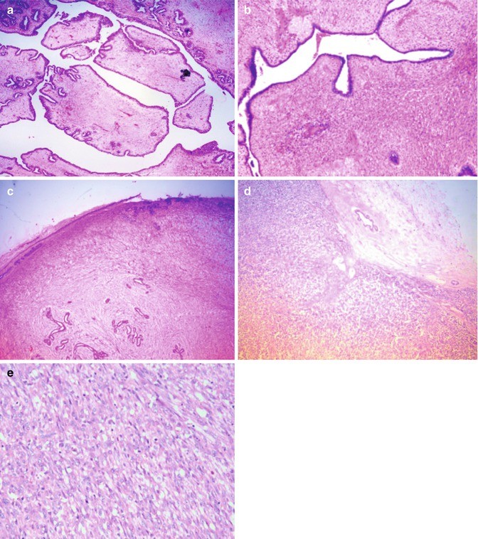 Phyllodes Tumors | SpringerLink