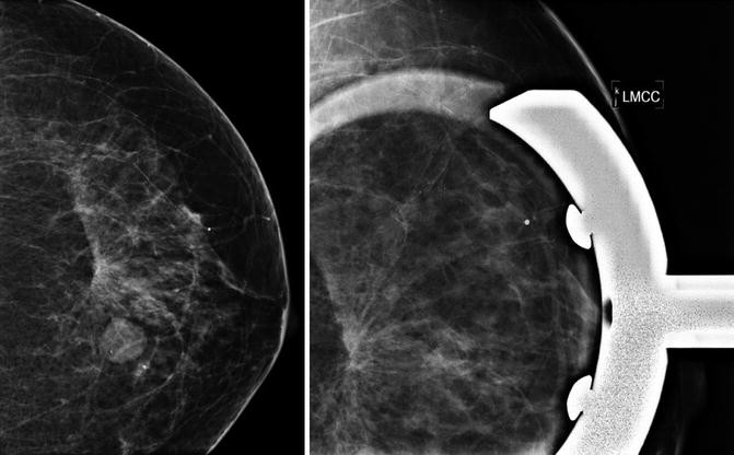 Step-by-Step Approach to Read a Mammogram | SpringerLink