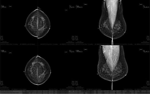 Step-by-Step Approach to Read a Mammogram | SpringerLink