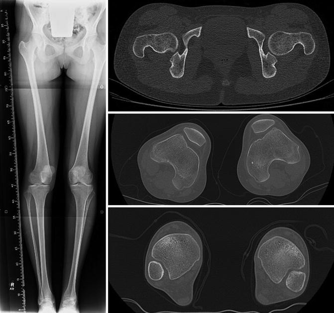 In-Toeing and Out-Toeing Gait | SpringerLink