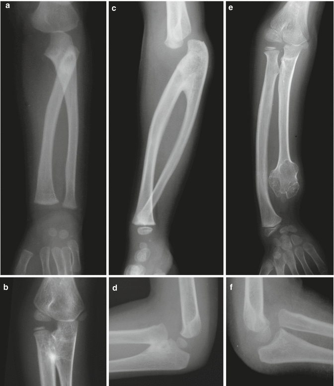 Deformities and Limitation of Motion of the Forearm | SpringerLink