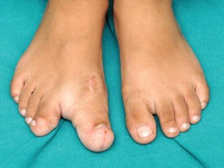 Localized Gigantism of the Limbs | SpringerLink