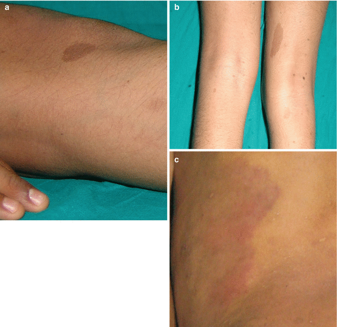 Localized Gigantism of the Limbs | SpringerLink