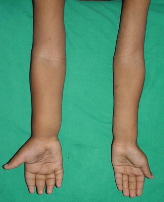 Localized Gigantism of the Limbs | SpringerLink