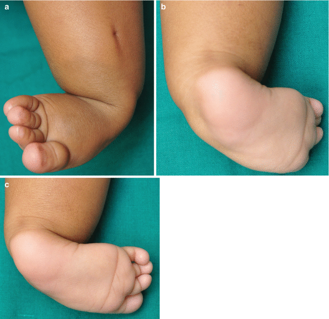 The Everted Foot | SpringerLink