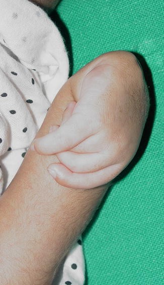 The Deformed Wrist | SpringerLink