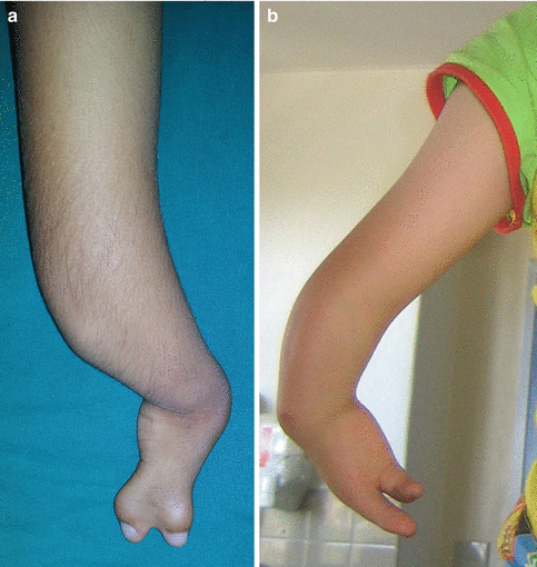 The Deformed Wrist | SpringerLink