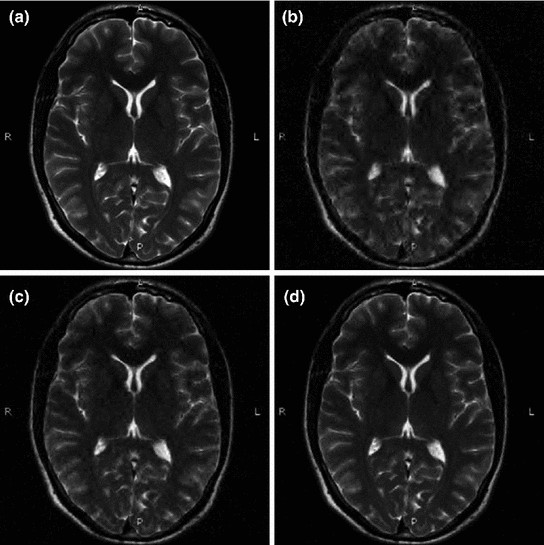 A Practical Under-Sampling Pattern for Compressed Sensing MRI ...