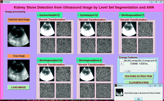 VLSI Implementation and Analysis of Kidney Stone Detection from Ultrasound Image by Level Set ...
