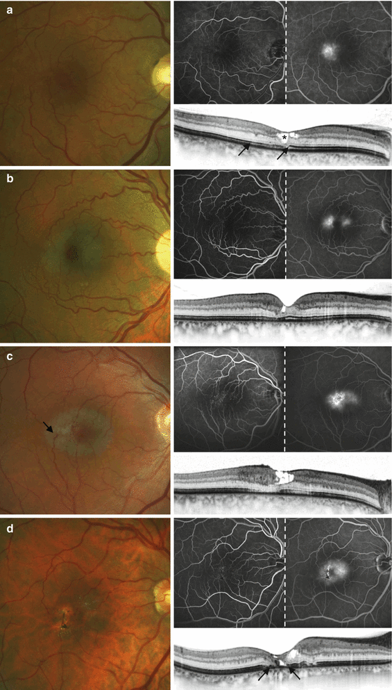 Macular Telangiectasia | SpringerLink