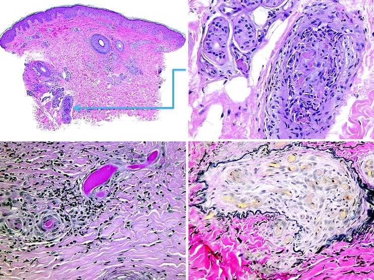 Cutaneous Cryoglobulinemic Vasculitis | SpringerLink