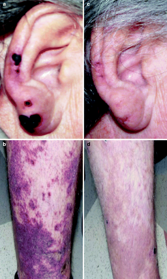 Novel Therapeutic Approaches to Cryoglobulinemia: Imatinib, Infliximab ...