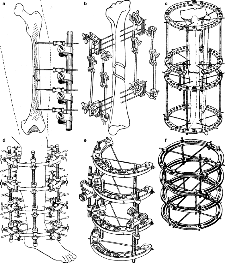 General and Special Aspects of External Fixation | SpringerLink