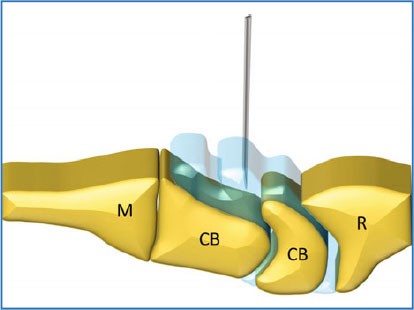 Radiocarpal Joint Injections | SpringerLink