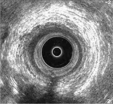 Cryptoglandular Fistulas | SpringerLink