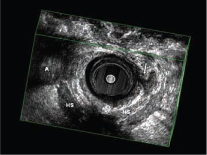 Cryptoglandular Fistulas | SpringerLink