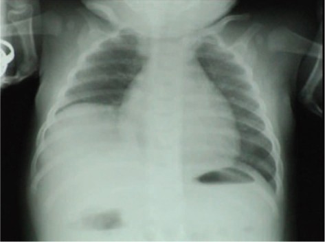 Diaphragmatic Eventration | SpringerLink