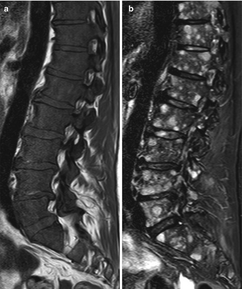 MRI of the Abnormal Bone Marrow: Diffuse Pattern | SpringerLink