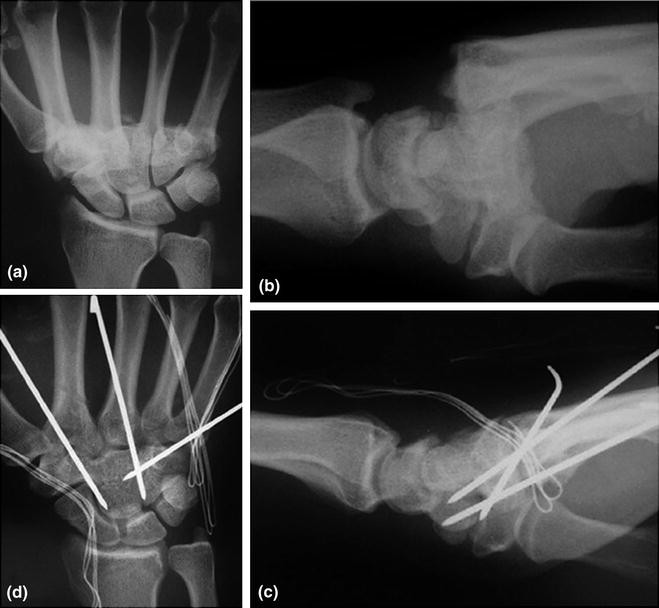 Carpometacarpal (CMC) Dislocations or Fractures-Dislocations Excluding ...