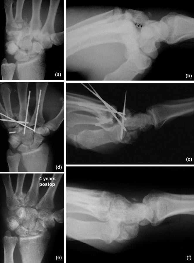 Carpometacarpal (CMC) Dislocations or Fractures-Dislocations Excluding ...
