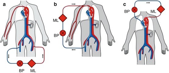 Basic Aspects of Physiology During ECMO Support | SpringerLink