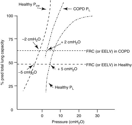 Static and Dynamic Hyperinflation in Chronic Obstructive Pulmonary ...