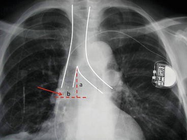 Evaluation Techniques of the PICC Tip Placement | SpringerLink