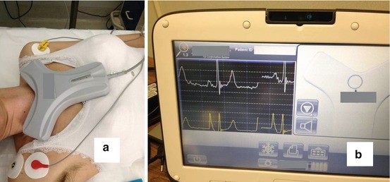 Evaluation Techniques of the PICC Tip Placement | SpringerLink