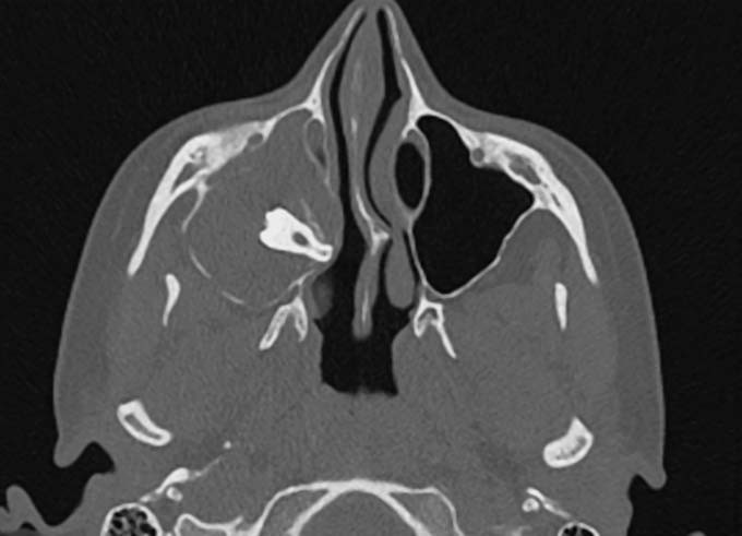 Afwijkingen van de sinus maxillaris | SpringerLink