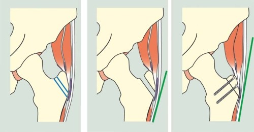 5a Addendum: tendinose van heupabductoren als oorzaak van het trochanter major pijnsyndroom ...