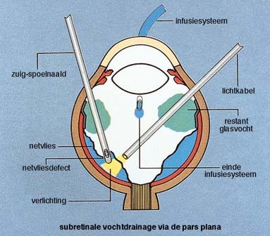 13 Retinale afwijkingen | SpringerLink