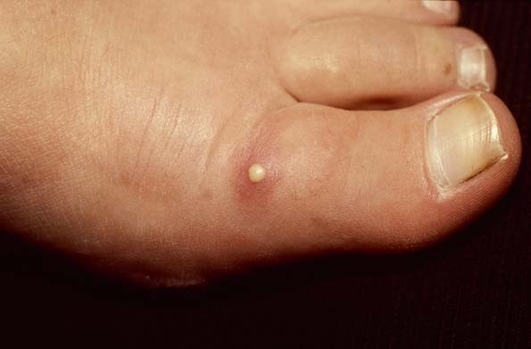 Efflorescenties: de elementen waaruit huidaandoeningen zijn opgebouwd ...