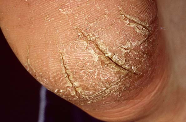 Efflorescenties: de elementen waaruit huidaandoeningen zijn opgebouwd ...