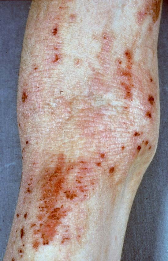 Efflorescenties: de elementen waaruit huidaandoeningen zijn opgebouwd ...