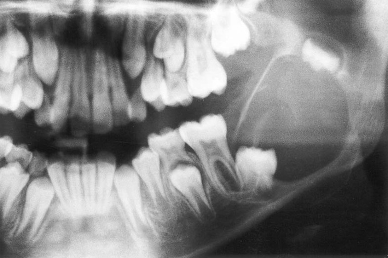 11 Dentogene cysten en tumoren | SpringerLink